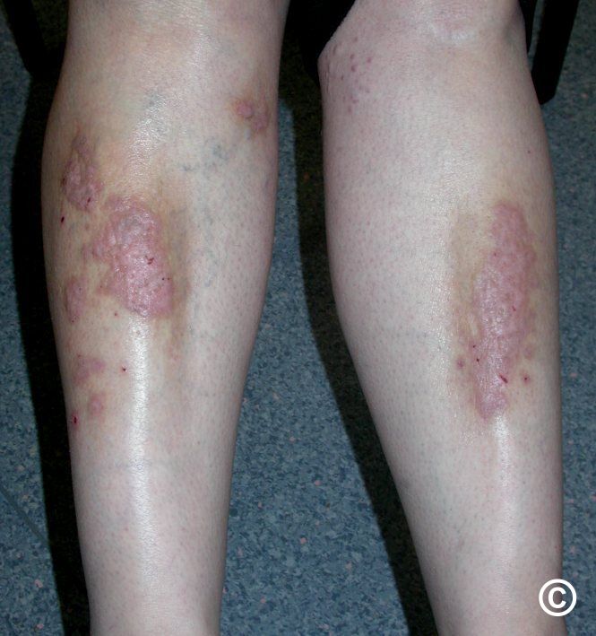 Lichen Planus: Causes, Symptoms, and Treatment Options