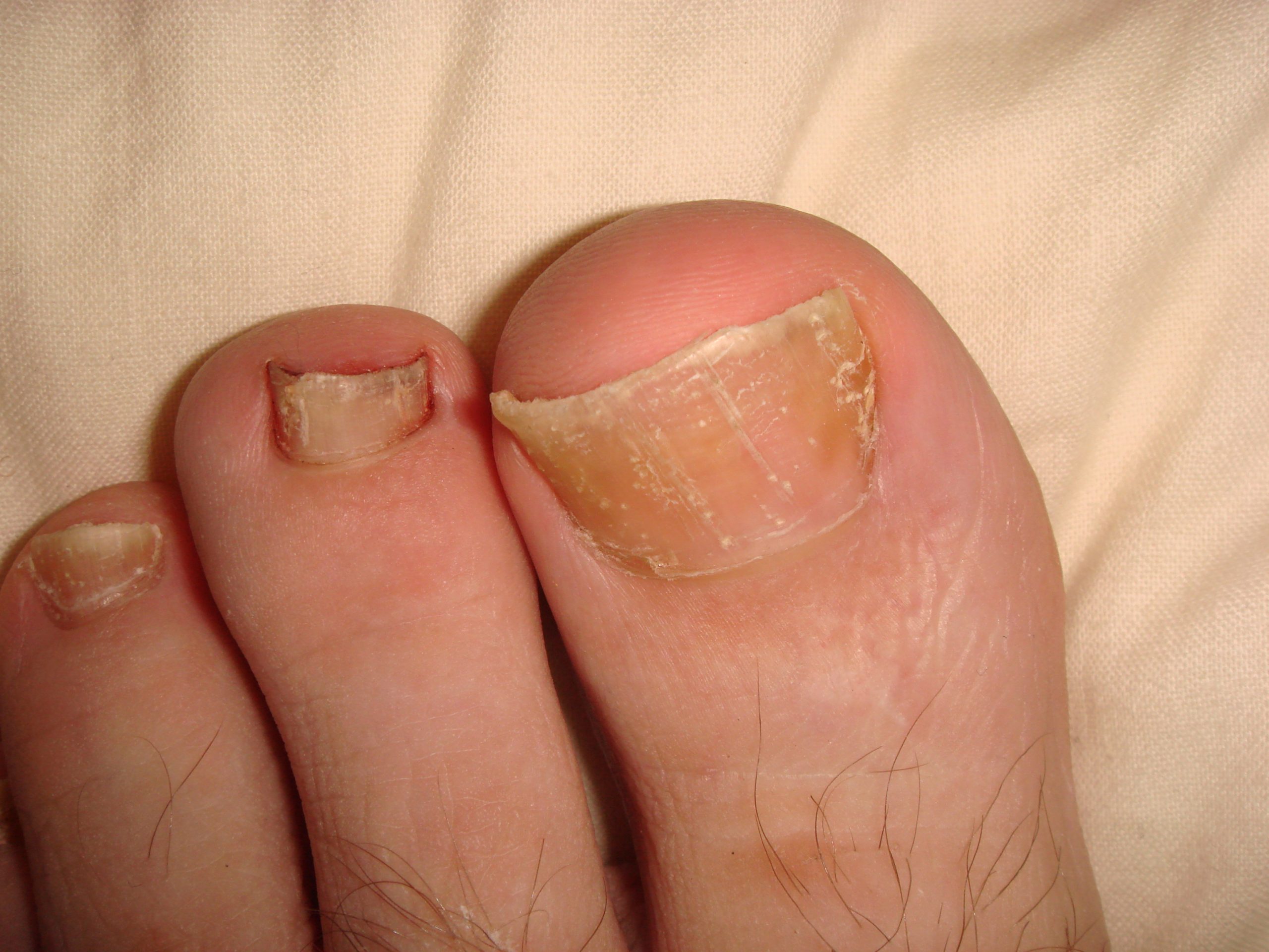 Nail psoriasis - Dermatologist consutlation Online - iDerma