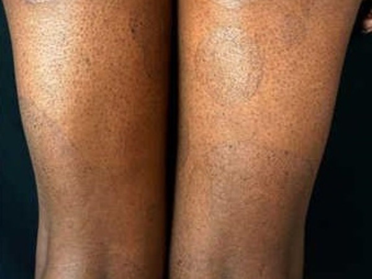 A paraneoplastic syndrome - Dermatologist consultation online