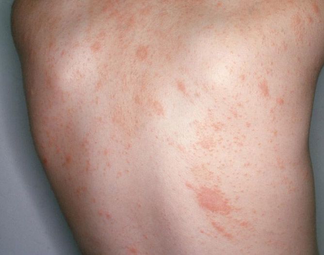 Pityriasis rosea - Dermatologist consultation online - iDerma